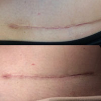 derma e Scar Gel Reviews 2019